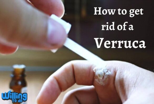 How to Get Rid of a Verruca Rapidly: Top 5 Effective Remedies